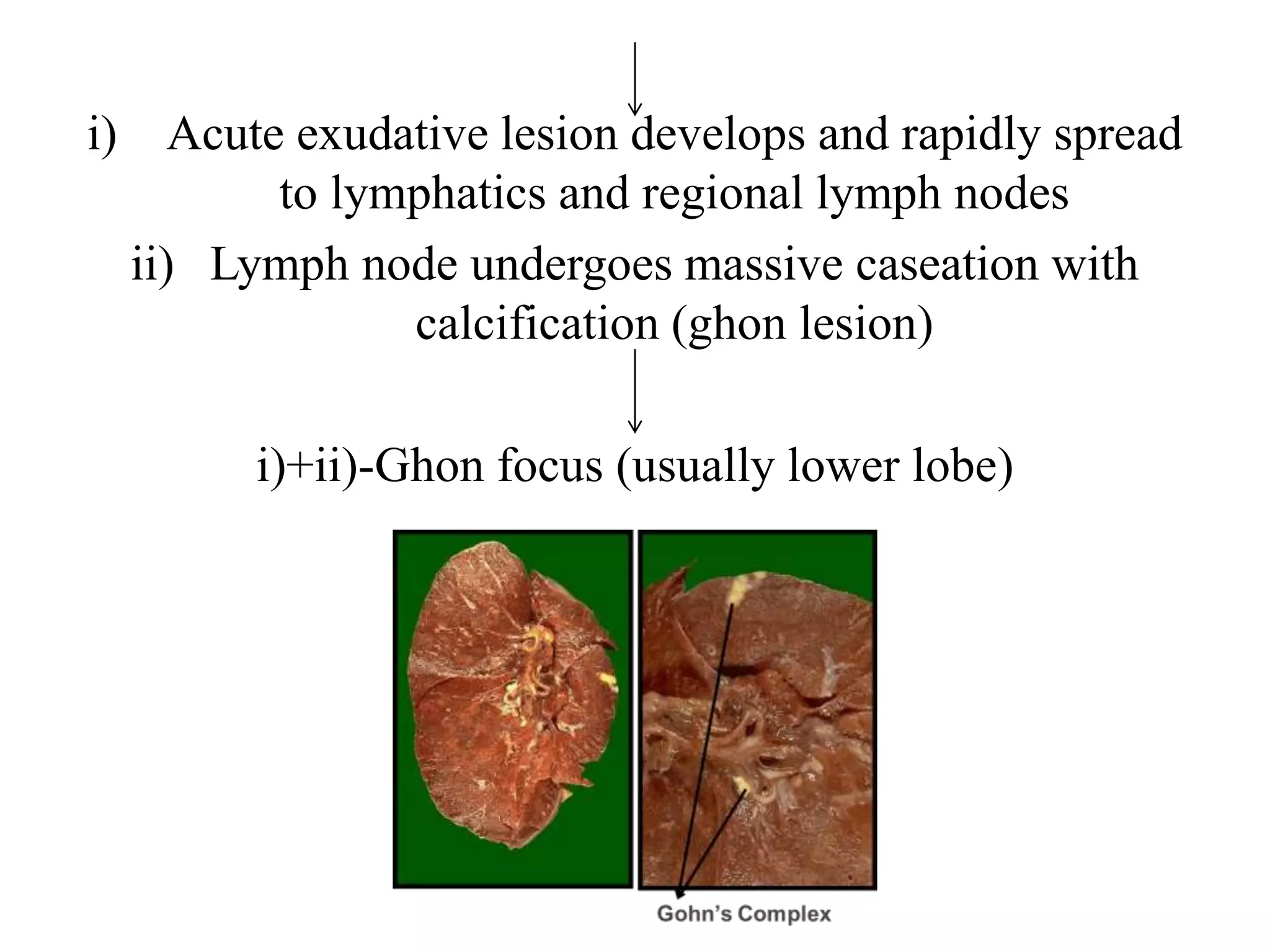 Mycobacterium tuberculosis | PPTX