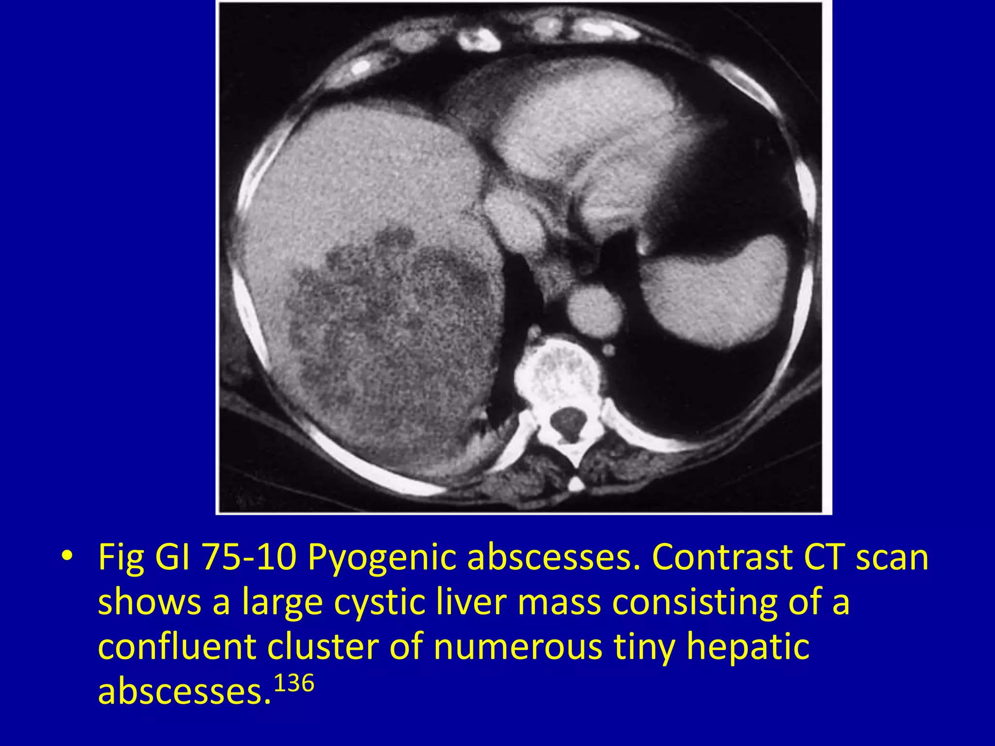 75 focal cystic lesions of the liver | PPTX
