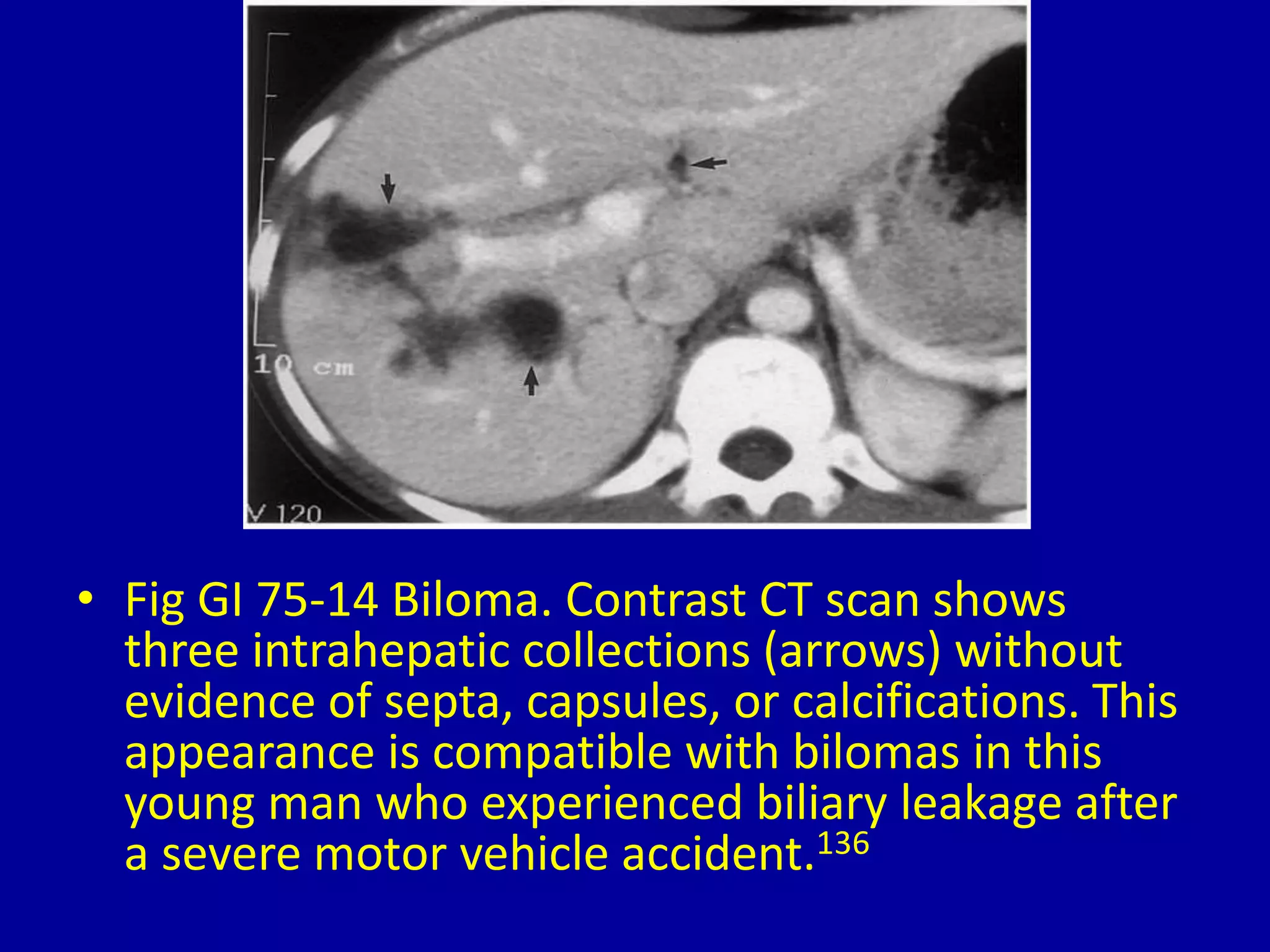 75 focal cystic lesions of the liver | PPTX