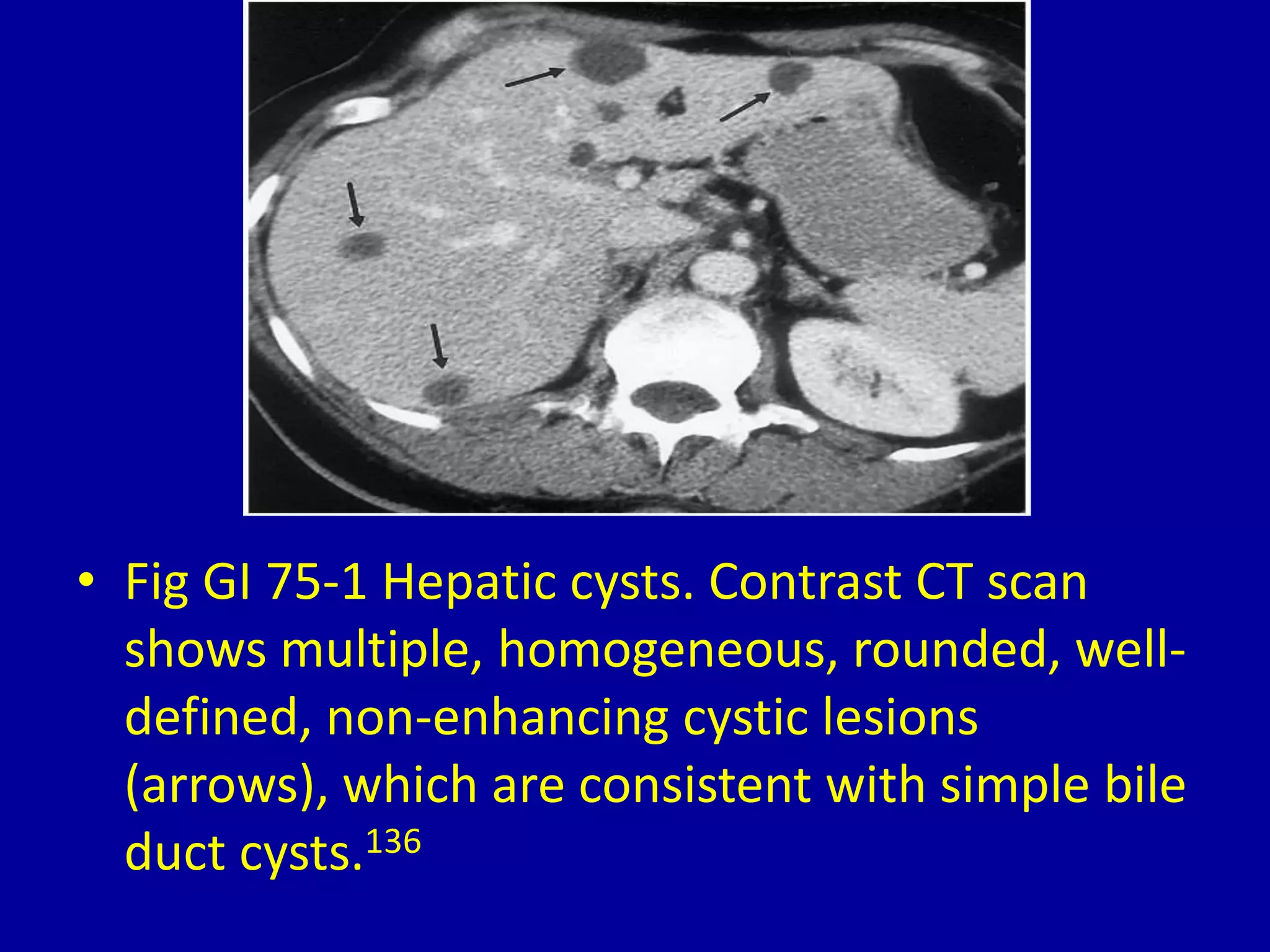 75 focal cystic lesions of the liver | PPTX