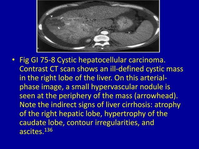 75 focal cystic lesions of the liver | PPTX | Medical Health