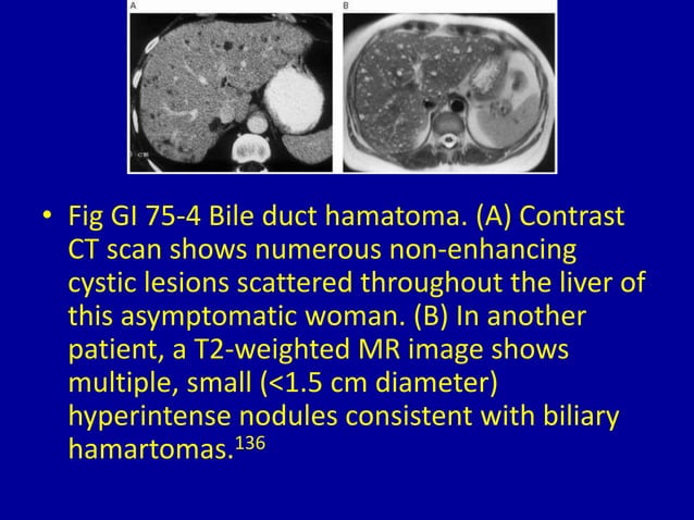 75 focal cystic lesions of the liver | PPTX | Medical Health