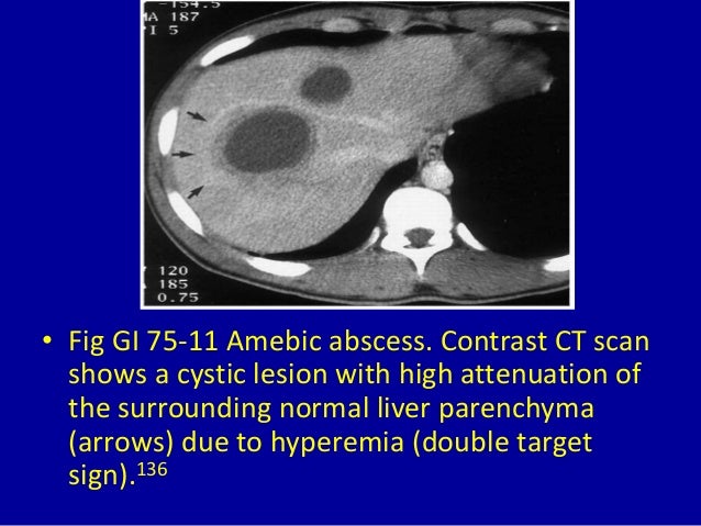 75 focal cystic lesions of the liver