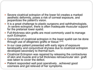 Full Thickness Skin Graft In Cicatricial Ectropion | PPTX