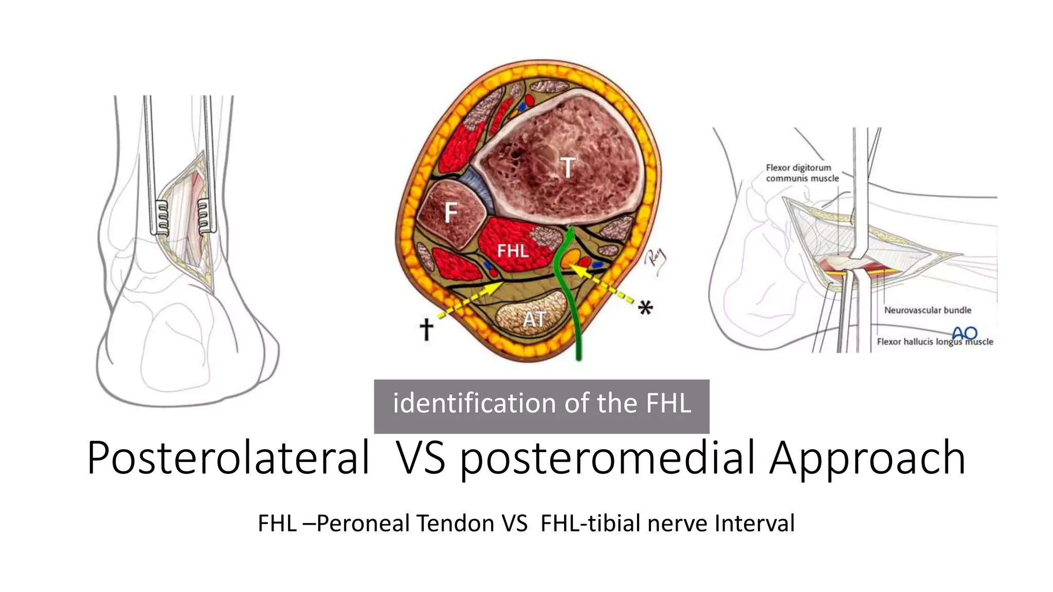 Ankle fracture: posterior malleolar fractures | PPTX