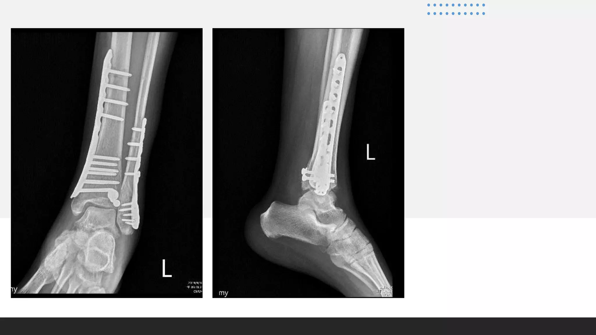 Ankle fracture: posterior malleolar fractures | PPTX