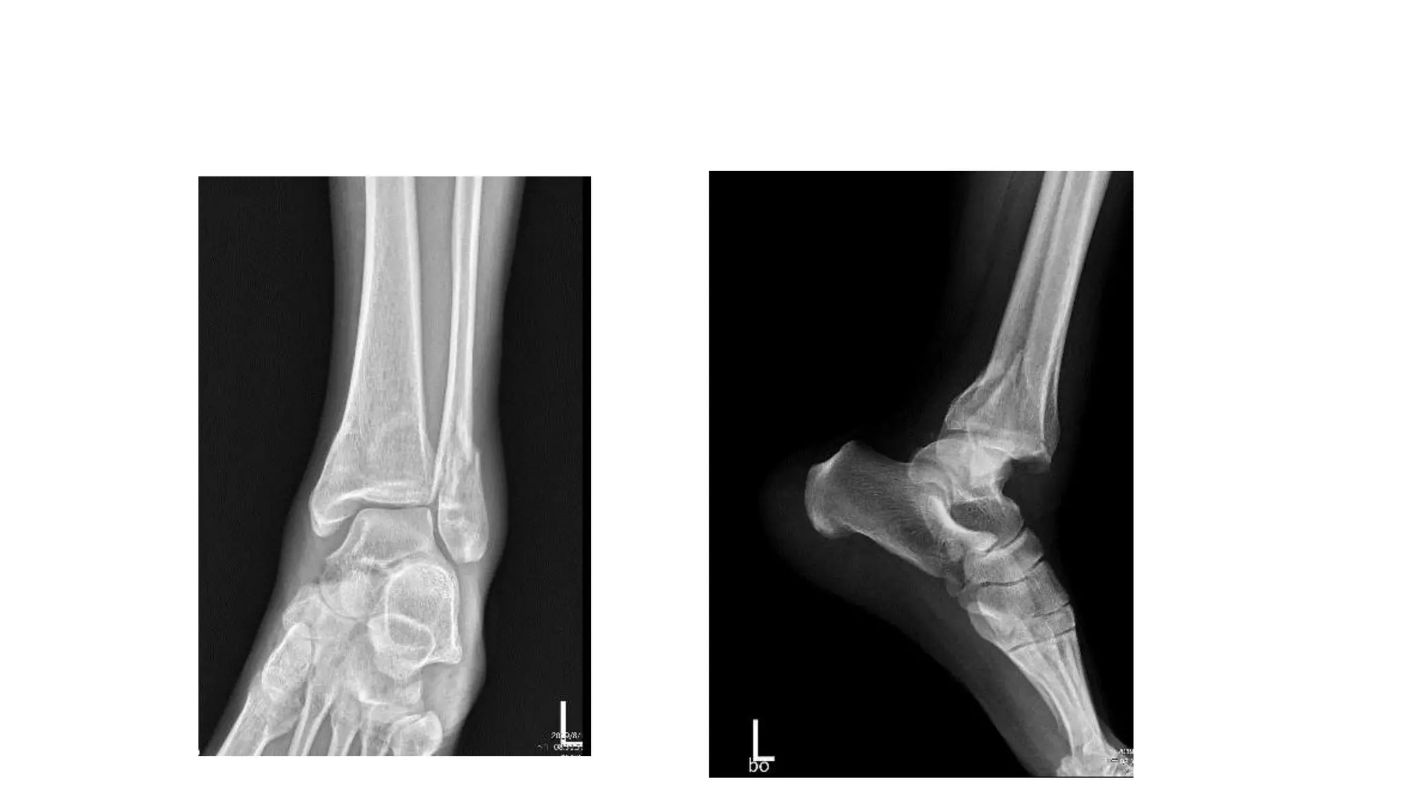 Ankle fracture: posterior malleolar fractures | PPTX