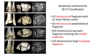 Ankle fracture: posterior malleolar fractures | PPTX