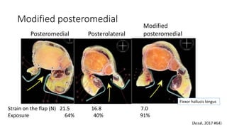 Ankle fracture: posterior malleolar fractures | PPTX