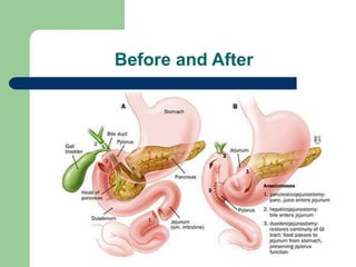 Whipple Procedure Animation