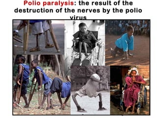 Polio pathophysiology | PPS