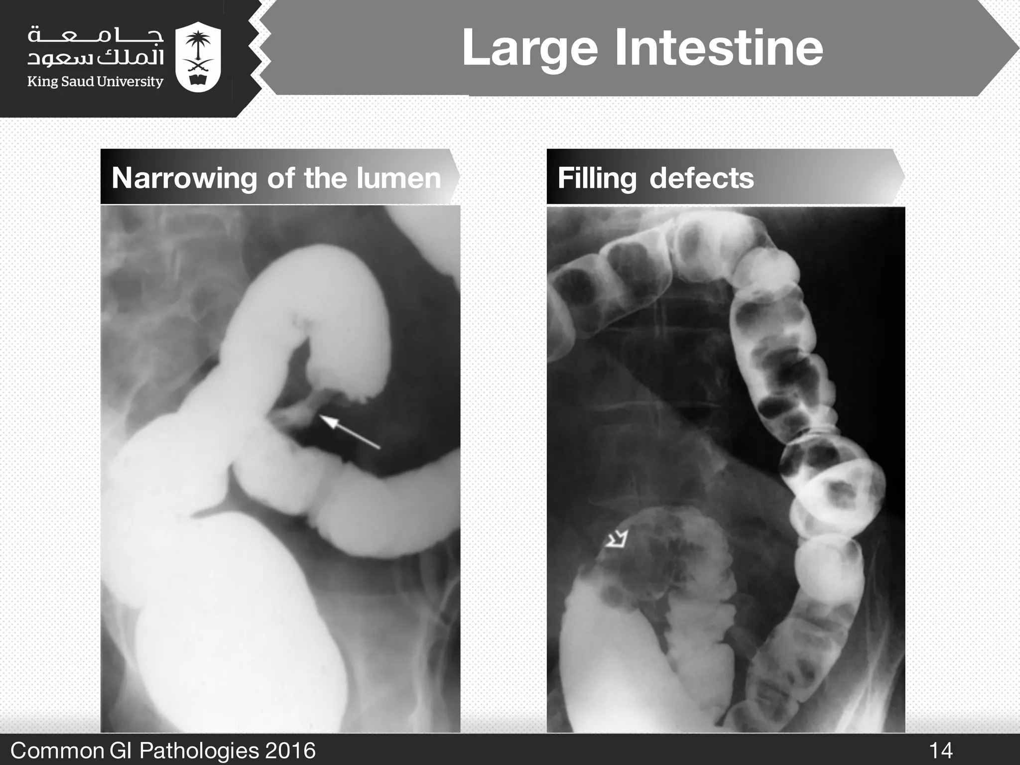 Common GI Pathologies | PDF