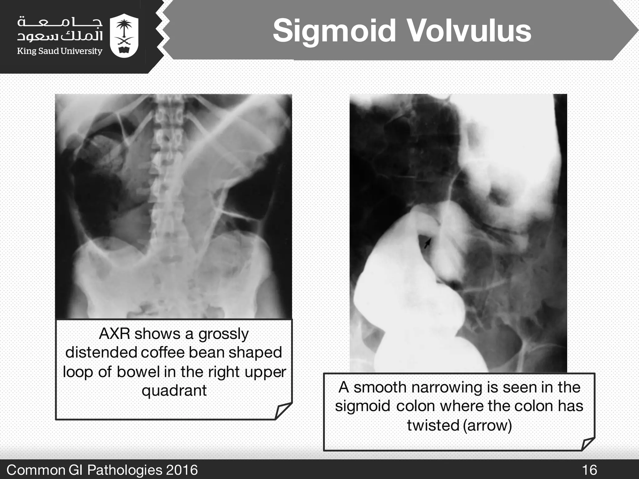Common GI Pathologies | PDF