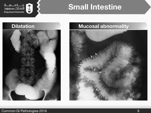 Common GI Pathologies | PDF