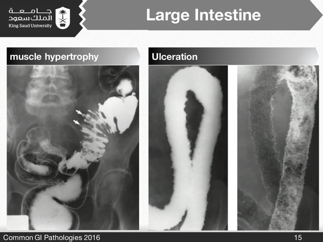 Common GI Pathologies | PDF