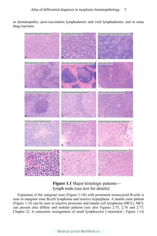 An Atlas Of Differential Diagnosis In Neoplastic Hematopathology ...