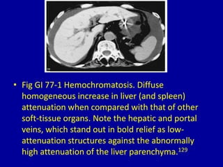 77 generalized increased attenuation of the liver | PPT