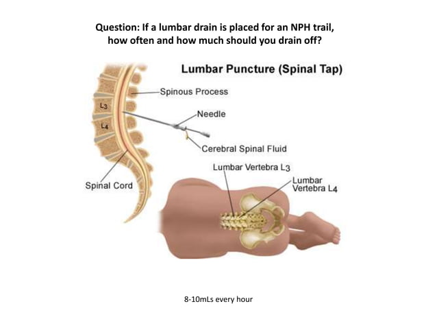 Lumbar Drains | PPTX | Brain and Nervous System Disorders | Diseases ...