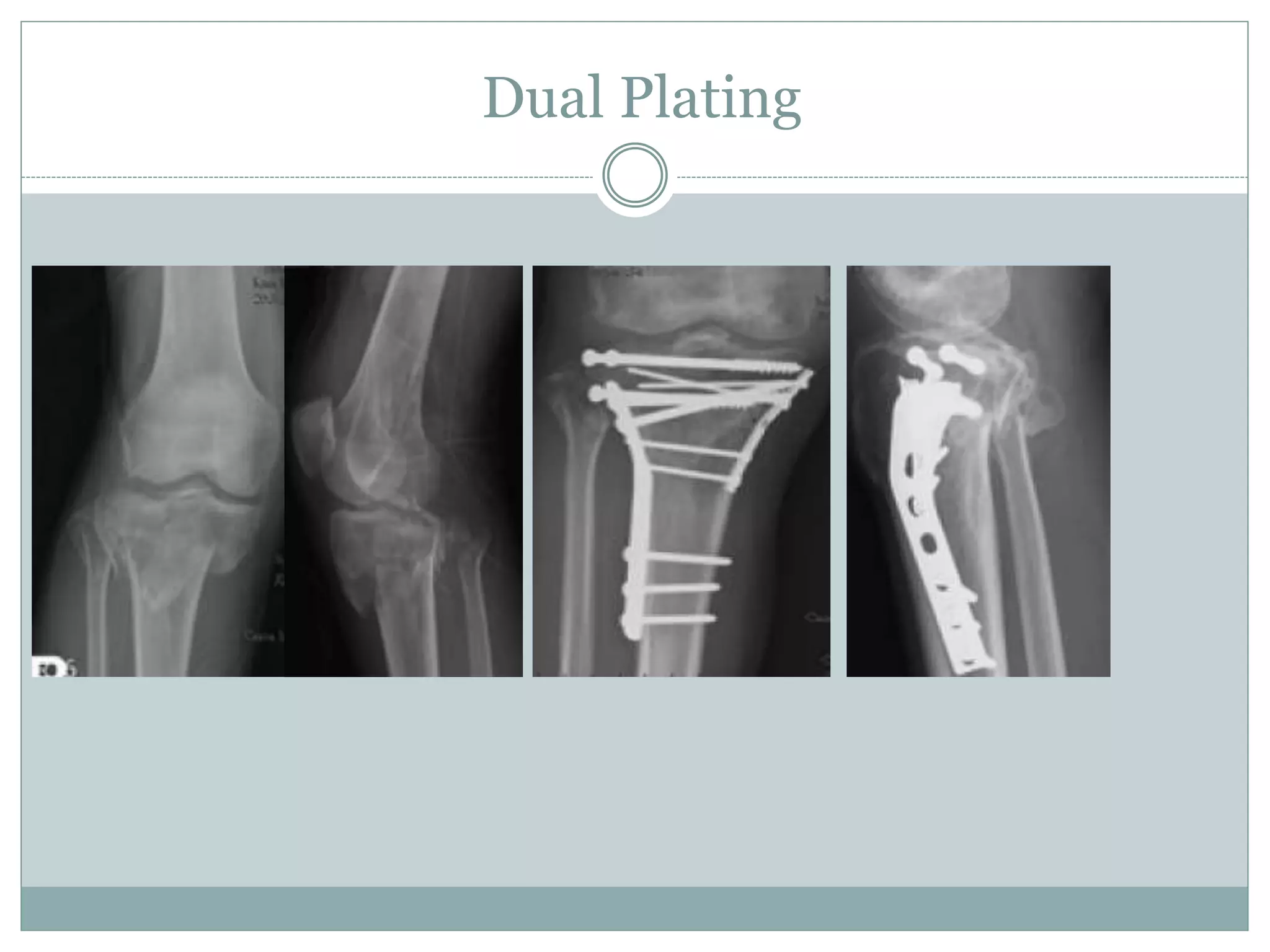 Comparative study of functional outcome of lateral locking plate ...