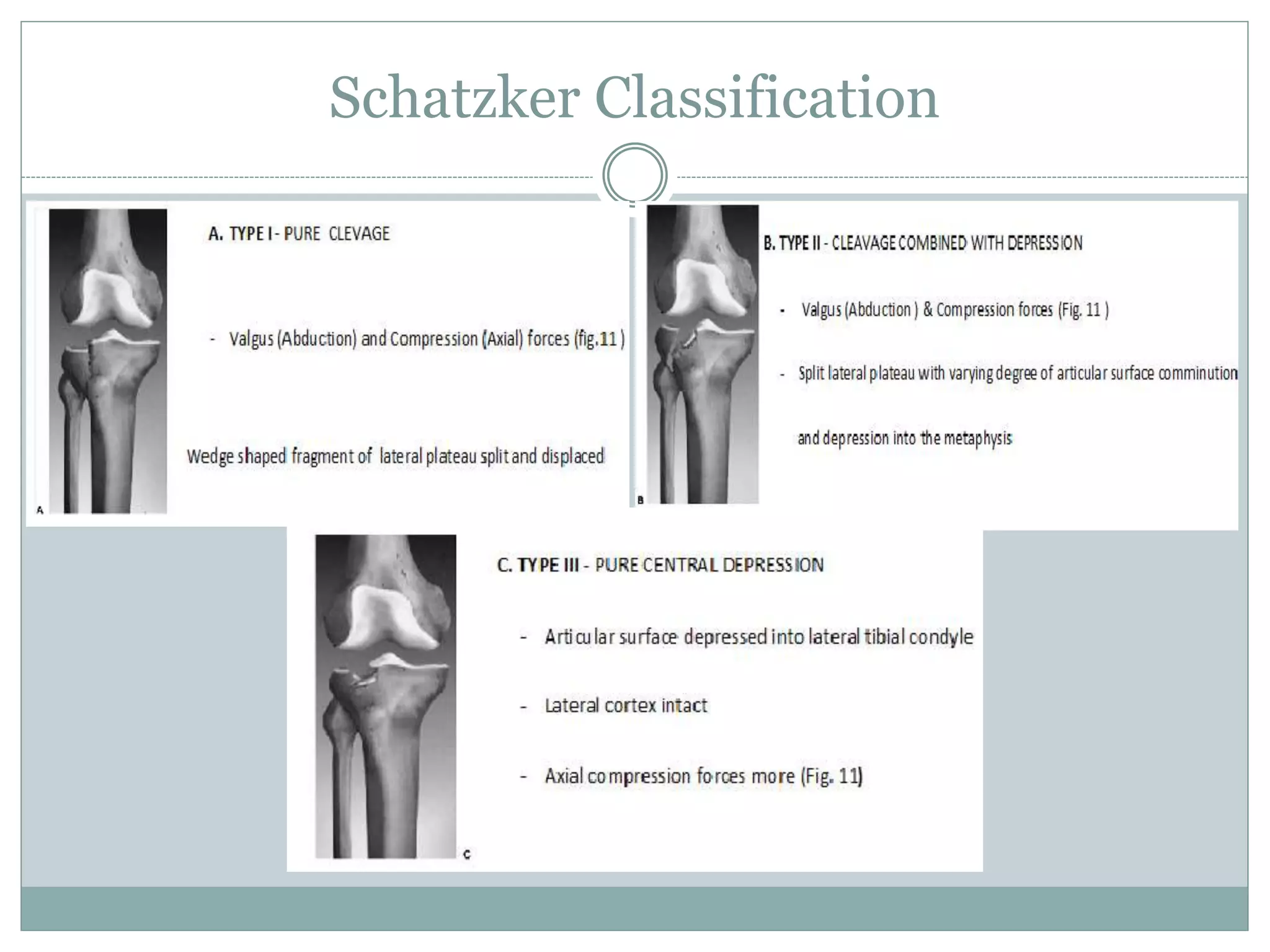 Comparative study of functional outcome of lateral locking plate ...
