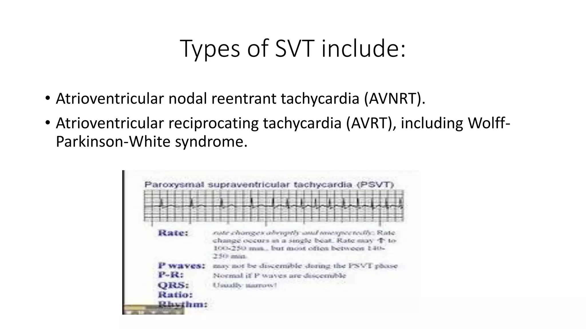 Supra Ventricle Trachycardia | PPTX