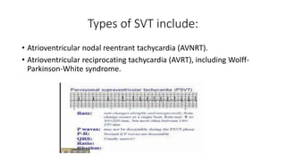 Supra Ventricle Trachycardia | PPTX
