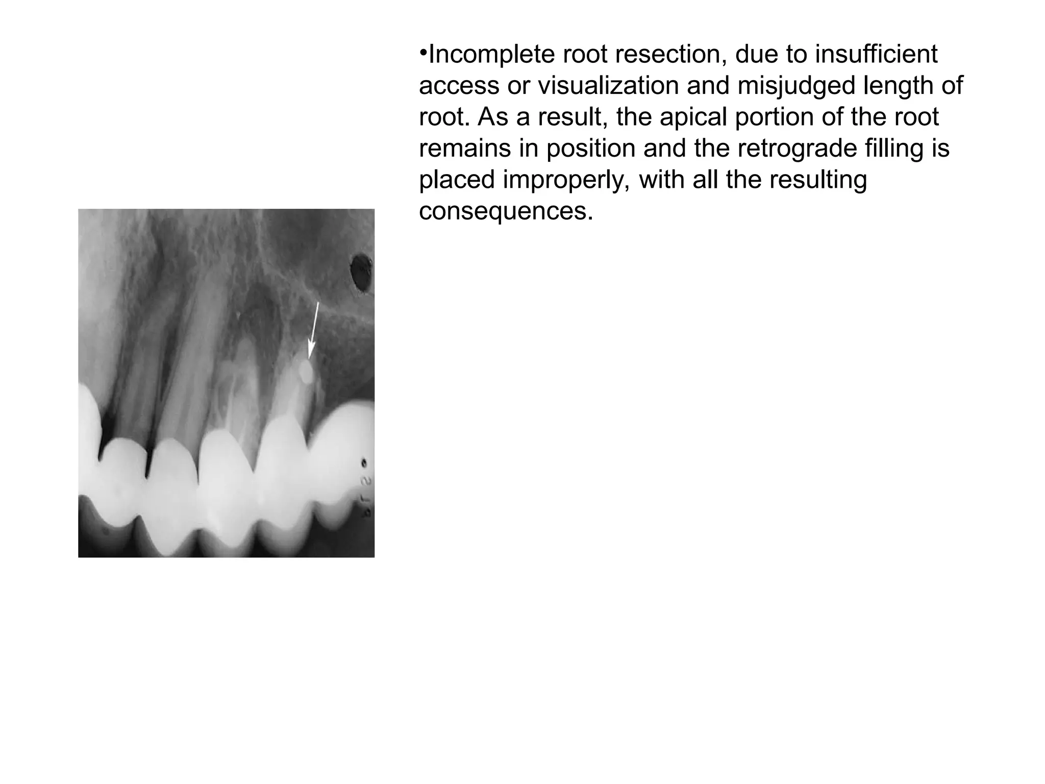 -apicoectomy in teeth with periapical lesions | PPT