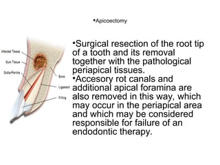 -apicoectomy in teeth with periapical lesions | PPT