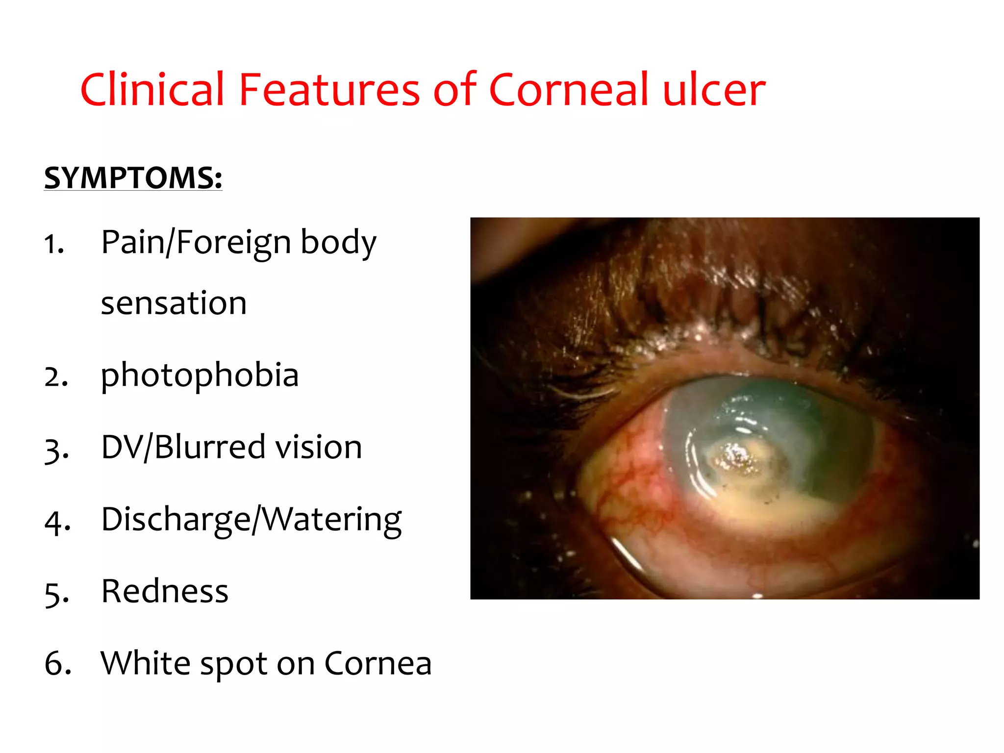 789_baterial_and_fungal_corneal_ulcers.pptx