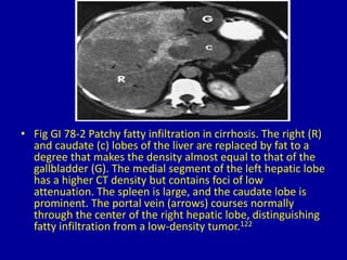 78 generalized decreased attenuation of the liver | PPTX