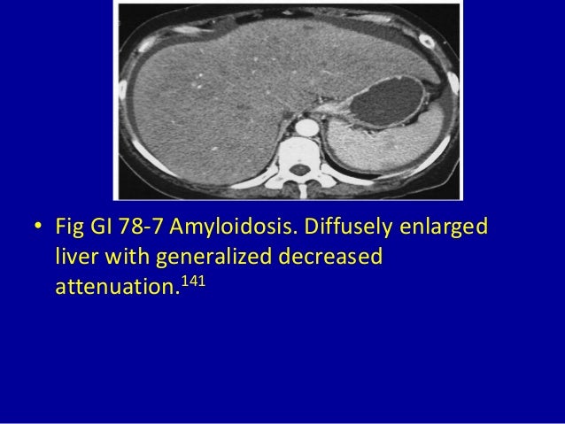 78 generalized decreased attenuation of the liver