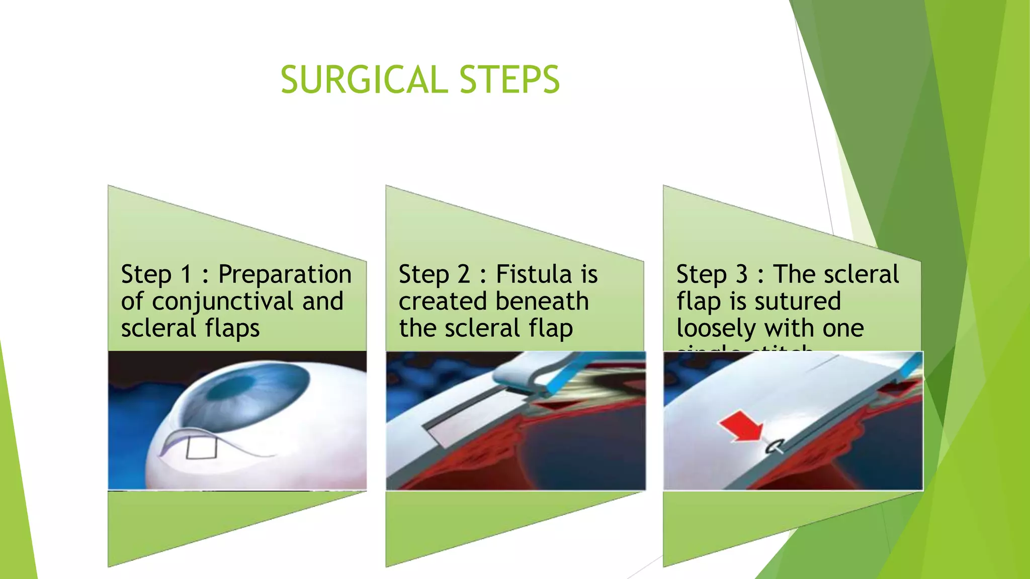 Ologen Implant-Replacing Mmc In Trabeculectomy | PPTX