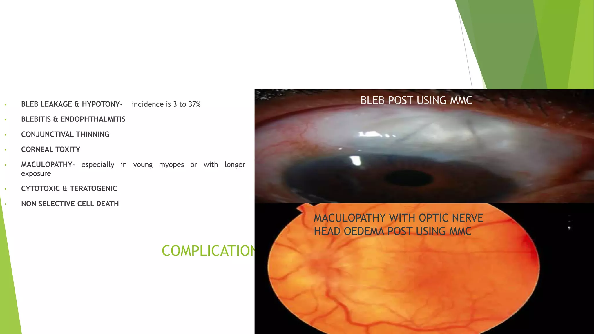 Ologen Implant-Replacing Mmc In Trabeculectomy | PPTX