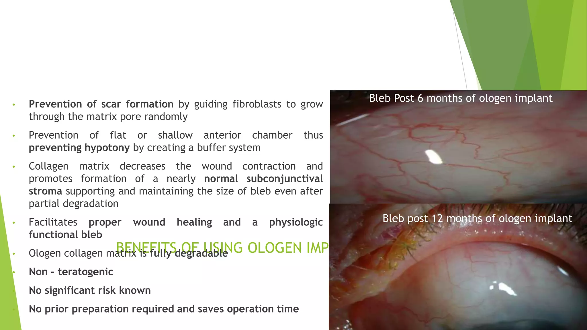 Ologen Implant-Replacing Mmc In Trabeculectomy | PPTX