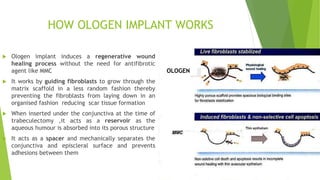 Ologen Implant-Replacing Mmc In Trabeculectomy | PPTX