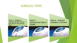 Ologen Implant-Replacing Mmc In Trabeculectomy | PPT