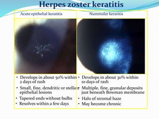 792_Viral__Protozoal_Corneal_Ulcer .pptx