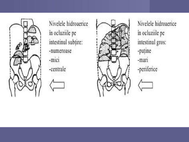 79488015 ocluzia-intestinala | PPT