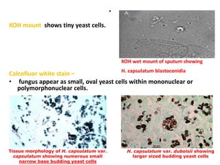 Histoplasmosis and Blastomycosis: Systemic mysosis | PDF