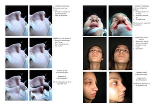 ZvesRhinoplasty | PDF