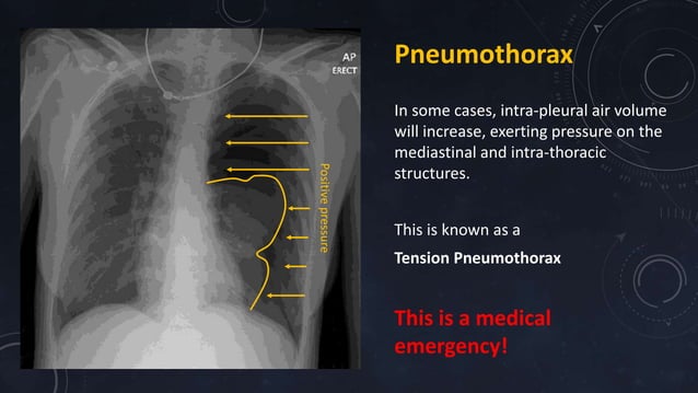Chest Interpretation Year 3 REVISED | PPTX | Lung and Respiratory ...