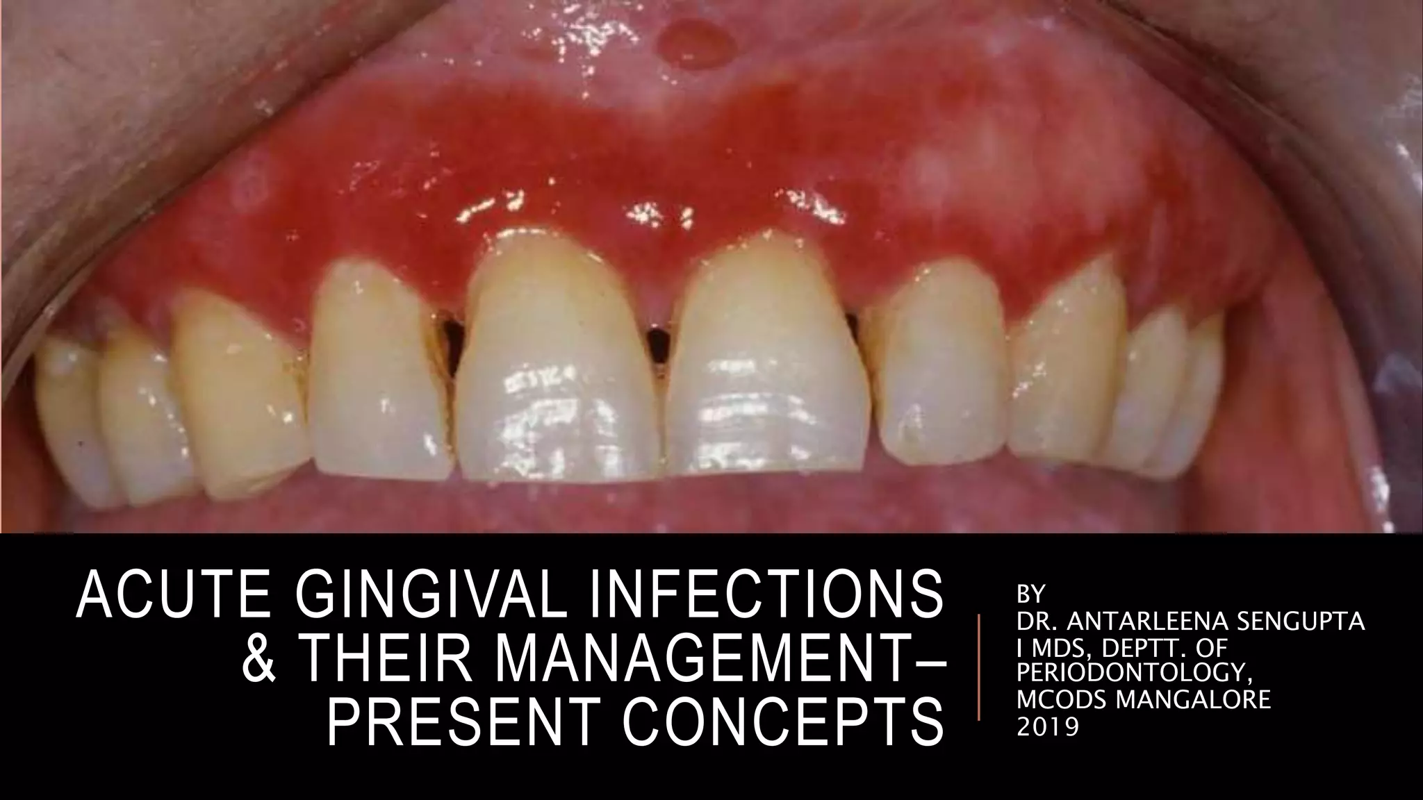 Acute Gingival Infections | PPTX