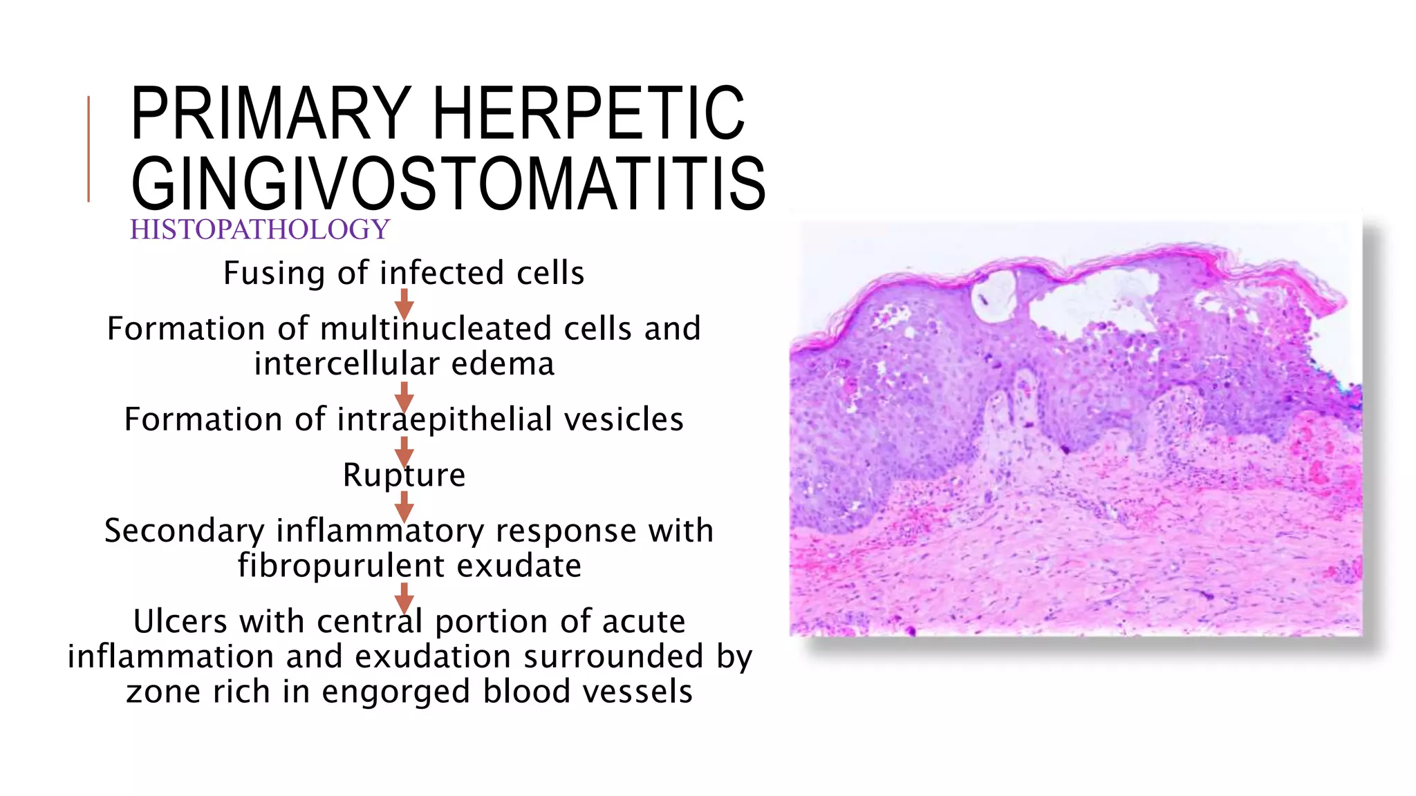 Acute Gingival Infections | PPTX