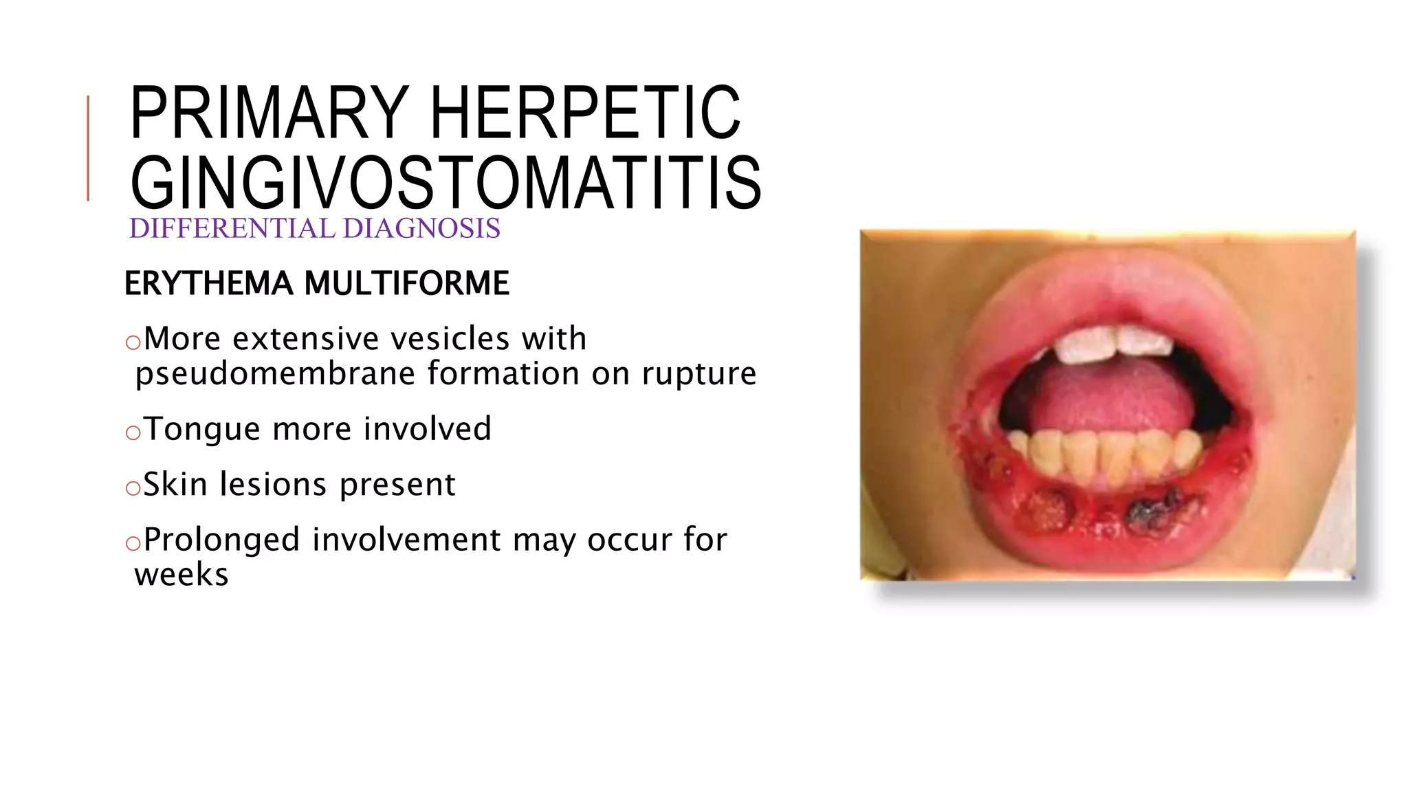 Acute Gingival Infections | PPTX