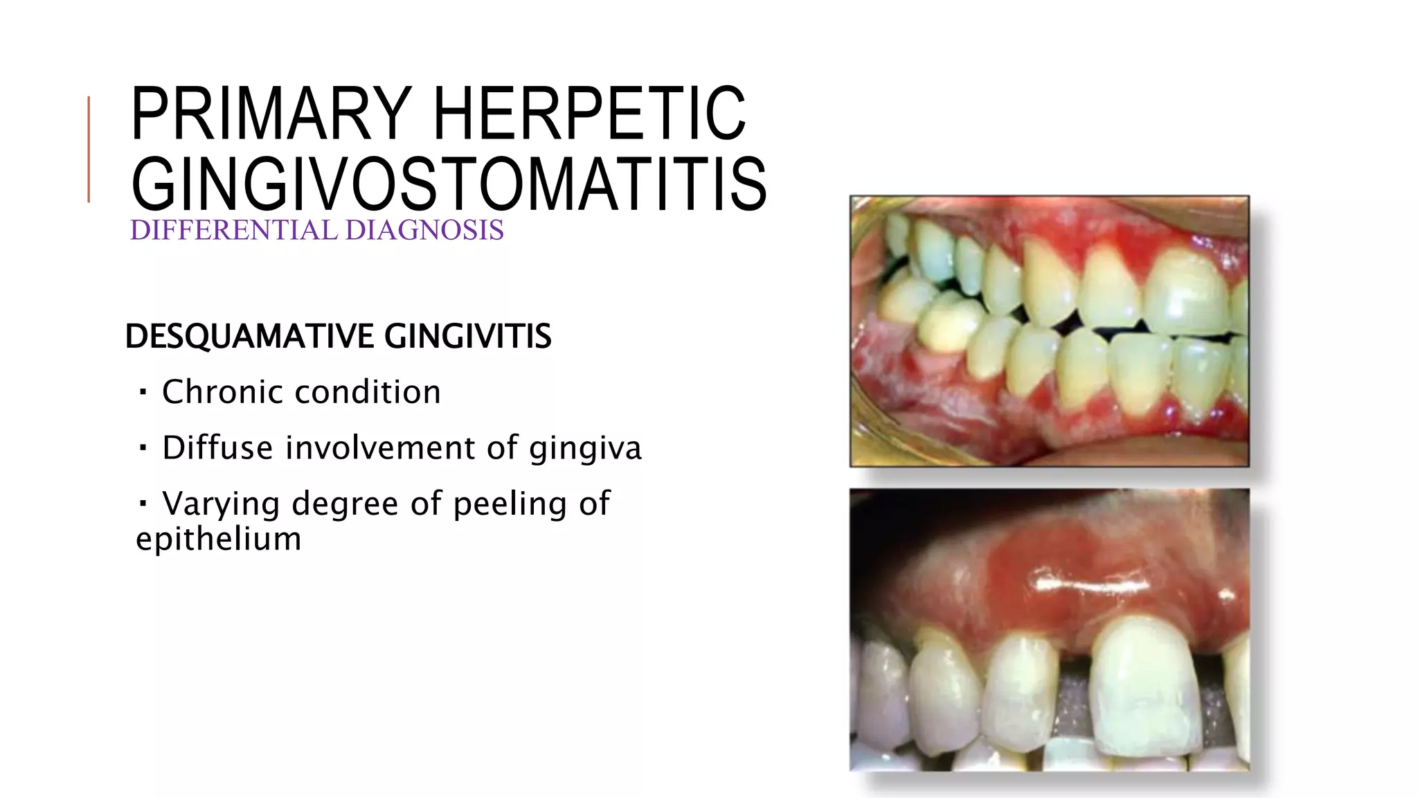 Acute Gingival Infections | PPTX