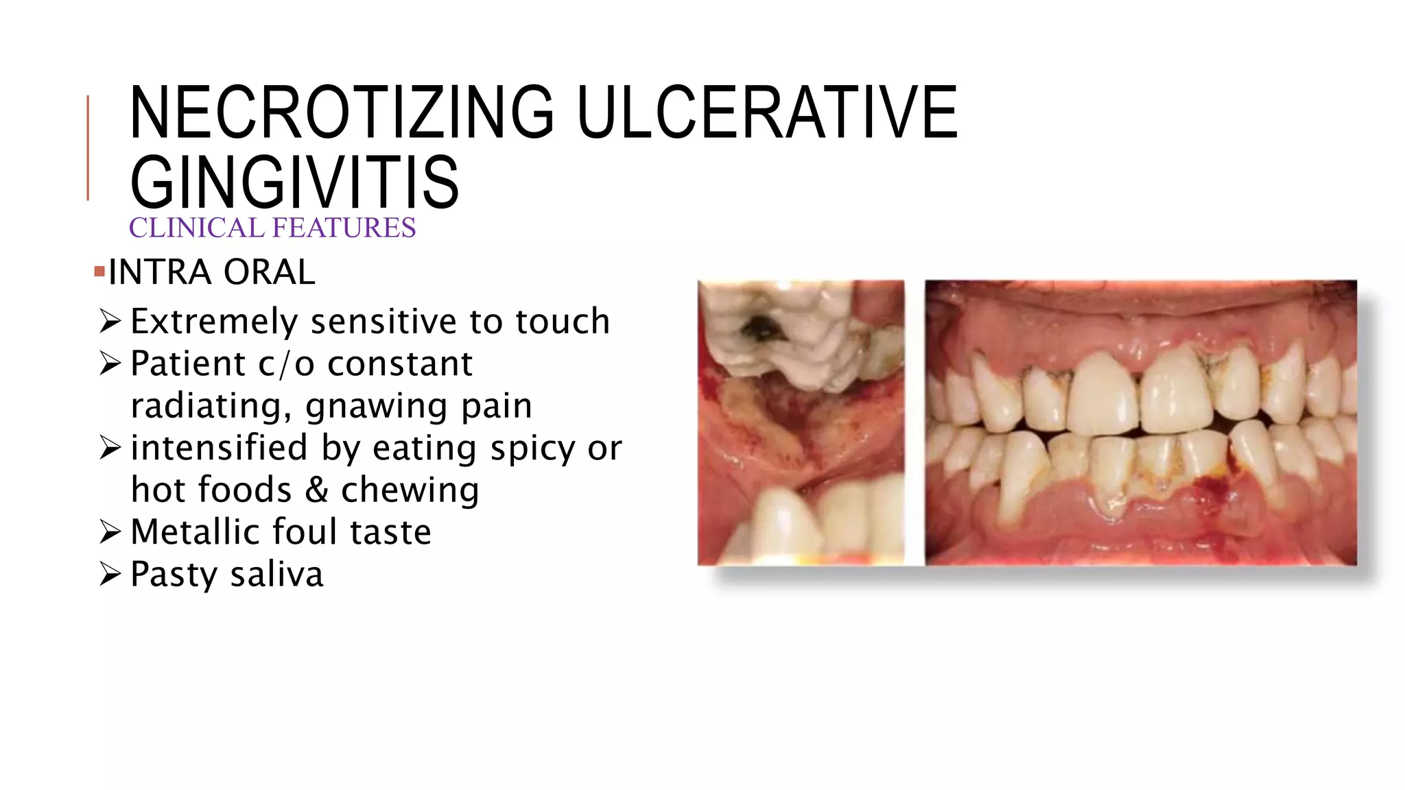 Acute Gingival Infections | PPTX