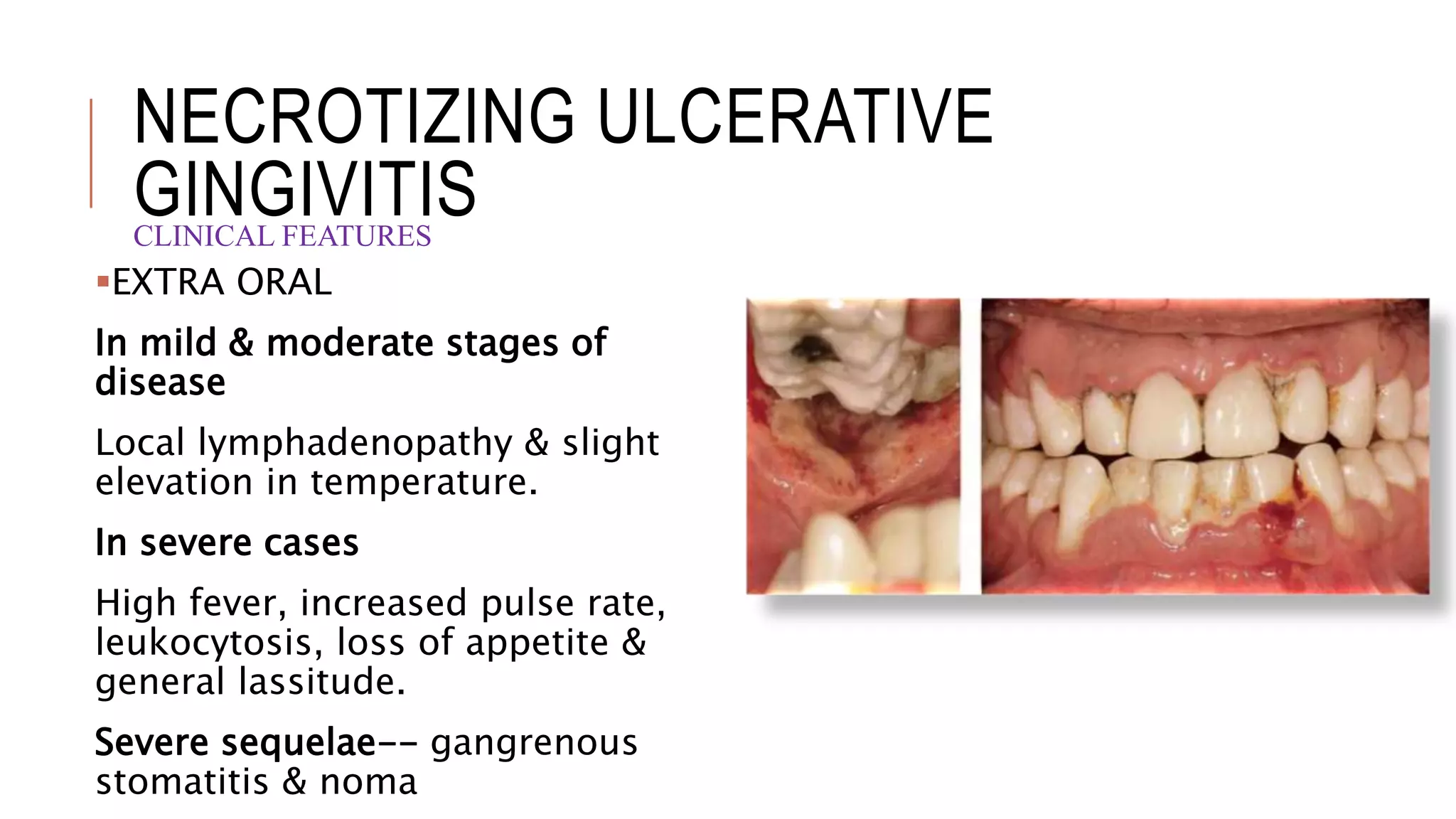Acute Gingival Infections | PPTX