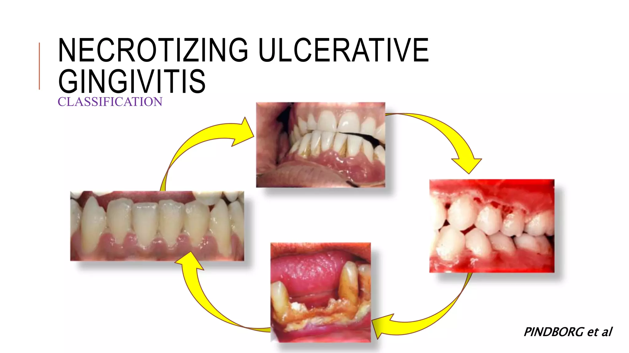 Acute Gingival Infections | PPTX