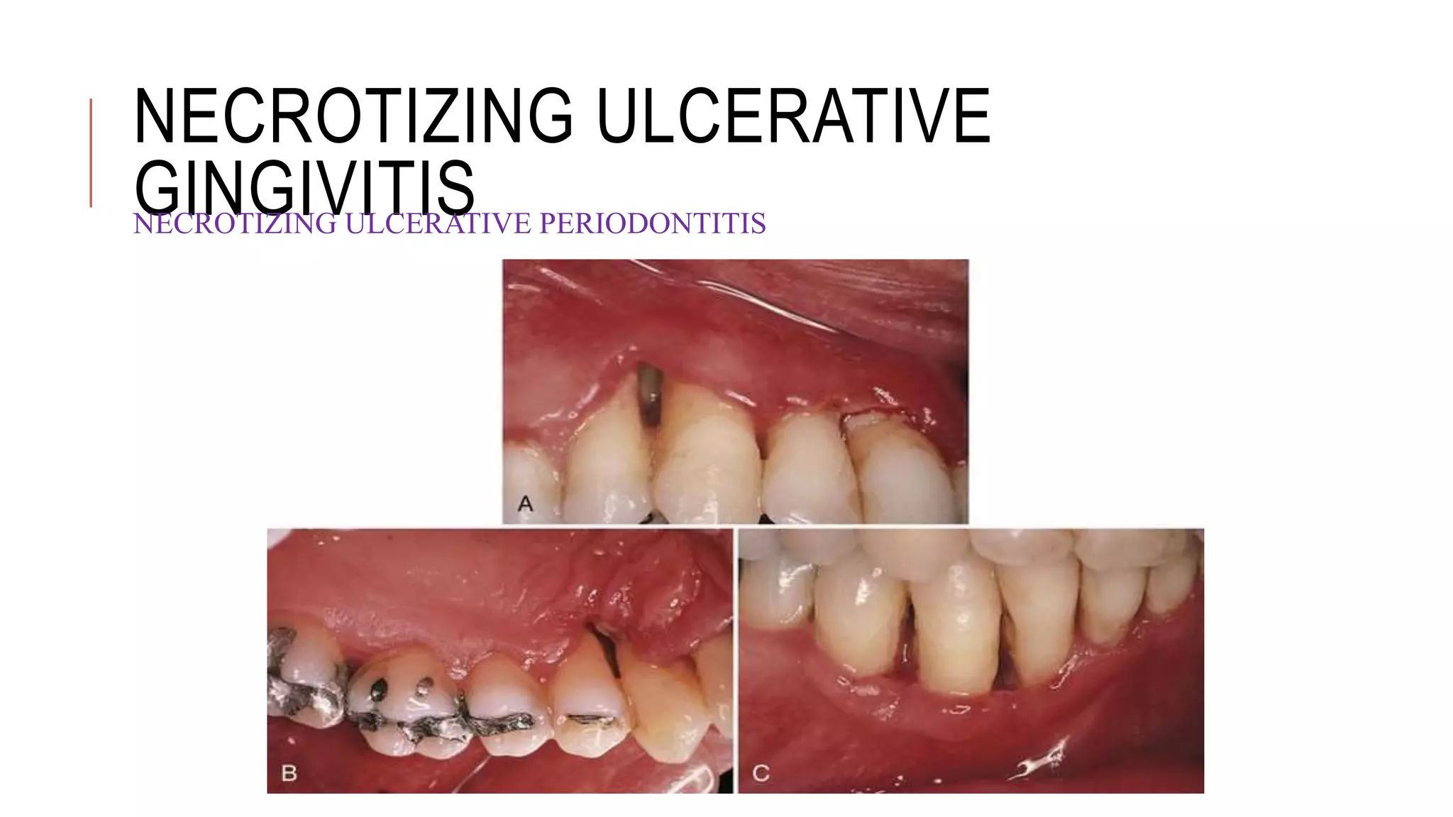 Acute Gingival Infections | PPTX