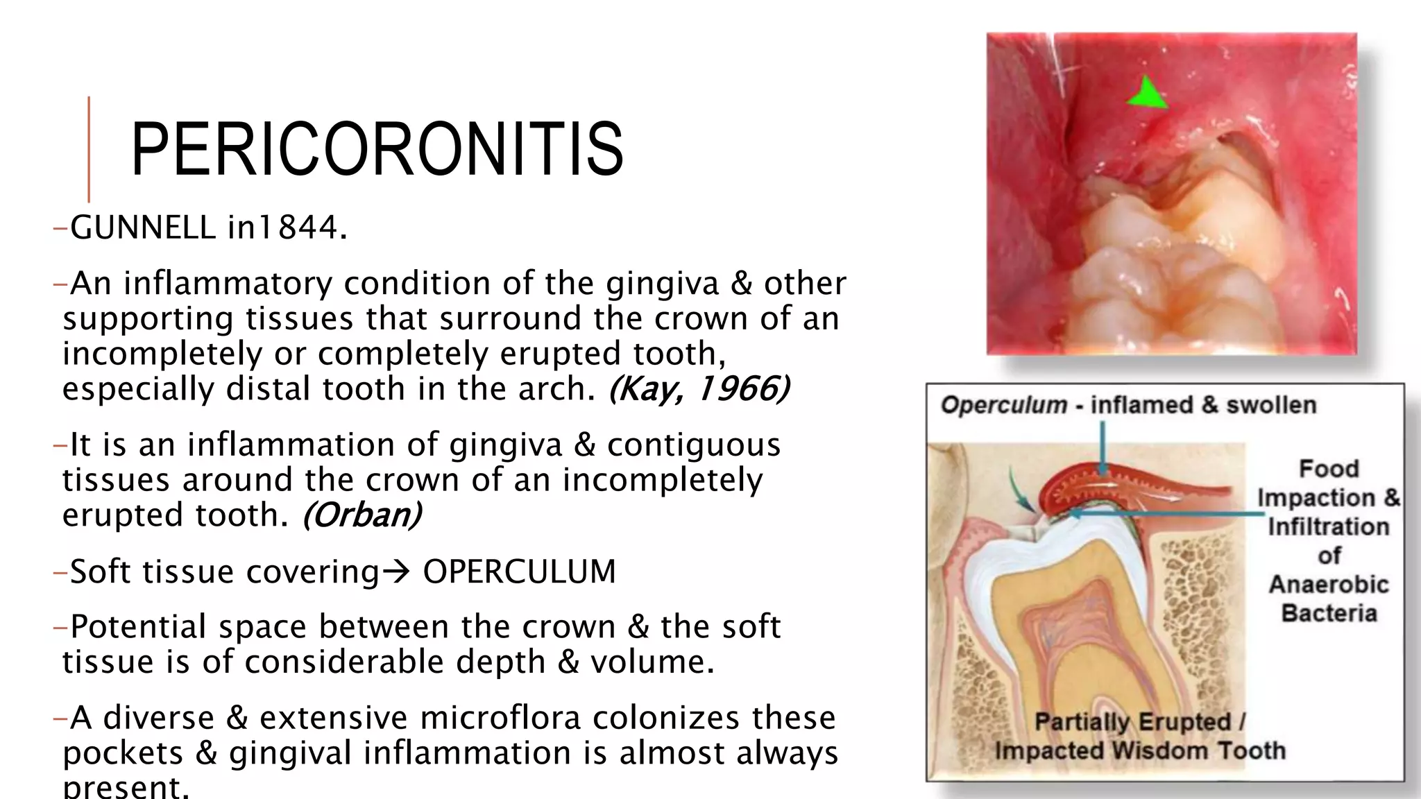 Acute Gingival Infections | PPTX